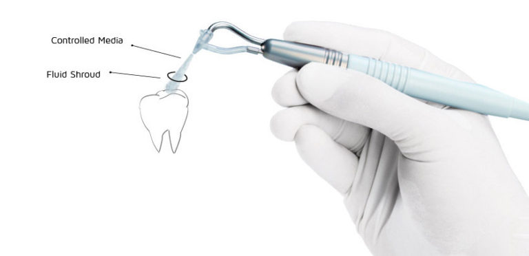 Air Abrasion San Diego - Dentist in San Diego