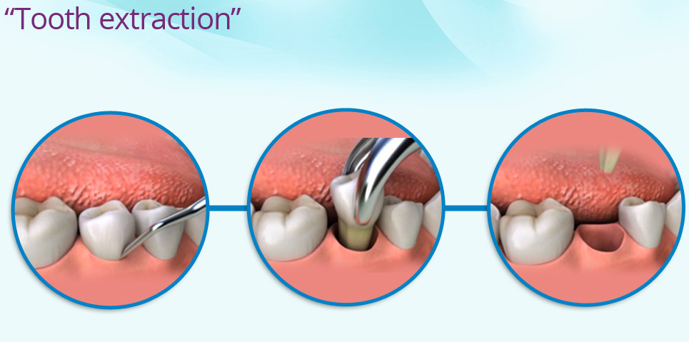 Tooth Extractions San Diego - Dentist in San Diego